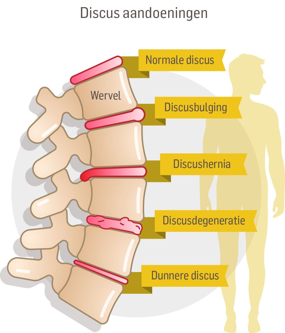 Rugpijn door zittend werk: oorzaken en tips | Dorsoo